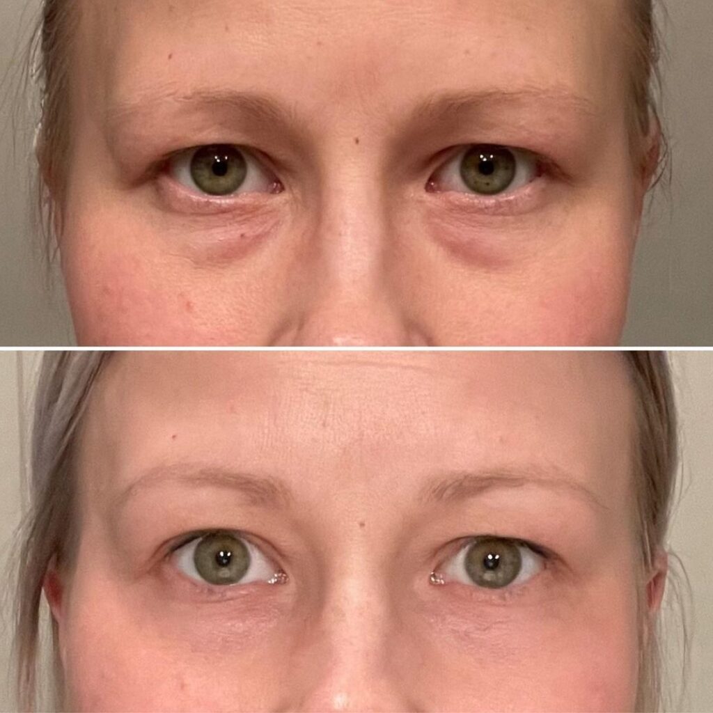 SmoothEye and LipLase - Frisco, TX Laser Eye and Lip Treatments